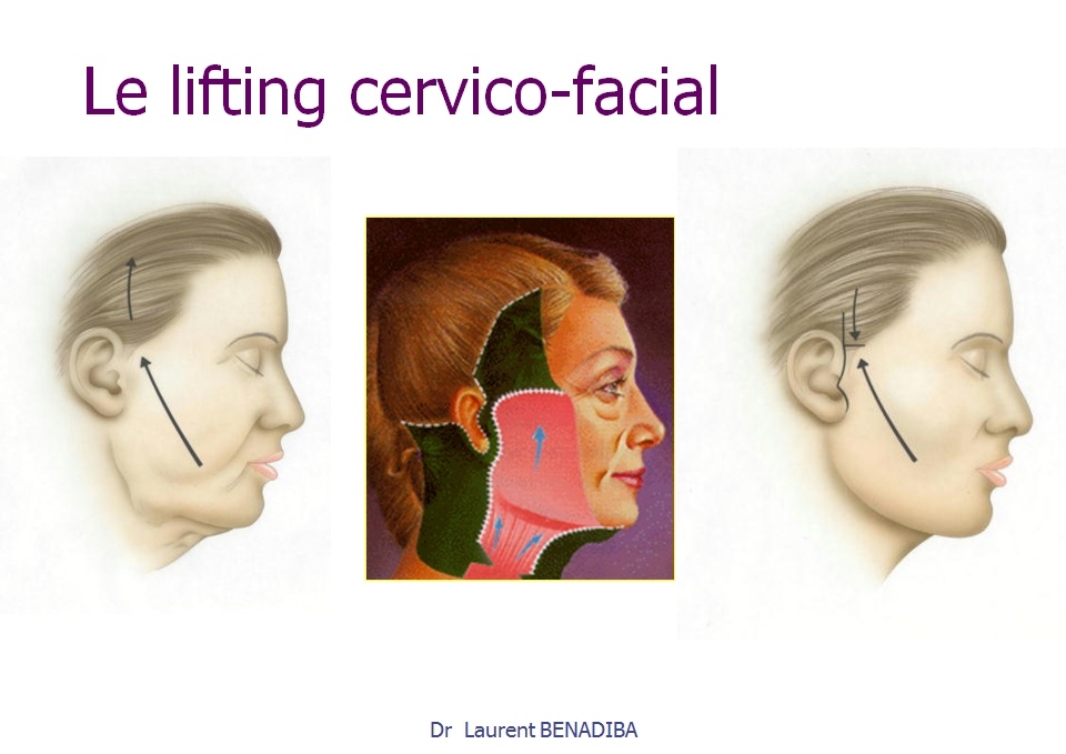 Mini facelift / Cervico-facial lifting in Paris & Geneva - Dr Benadiba